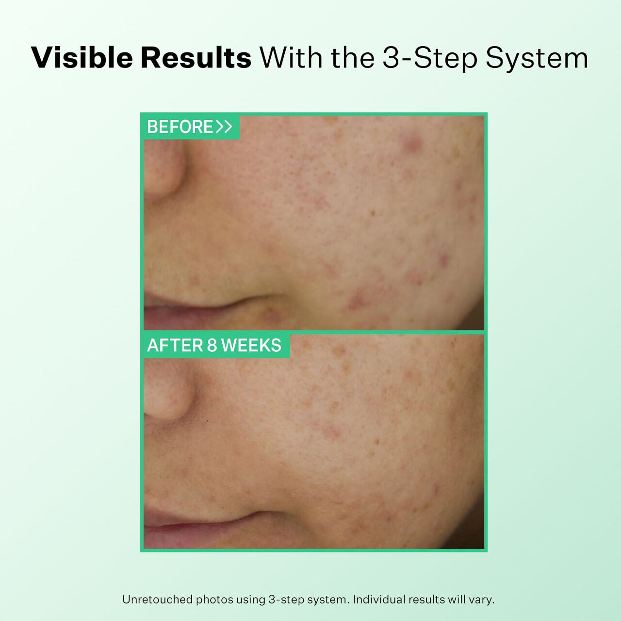 Multi Action Clear Acne Clearing Treatment Lotion For Breakouts ...