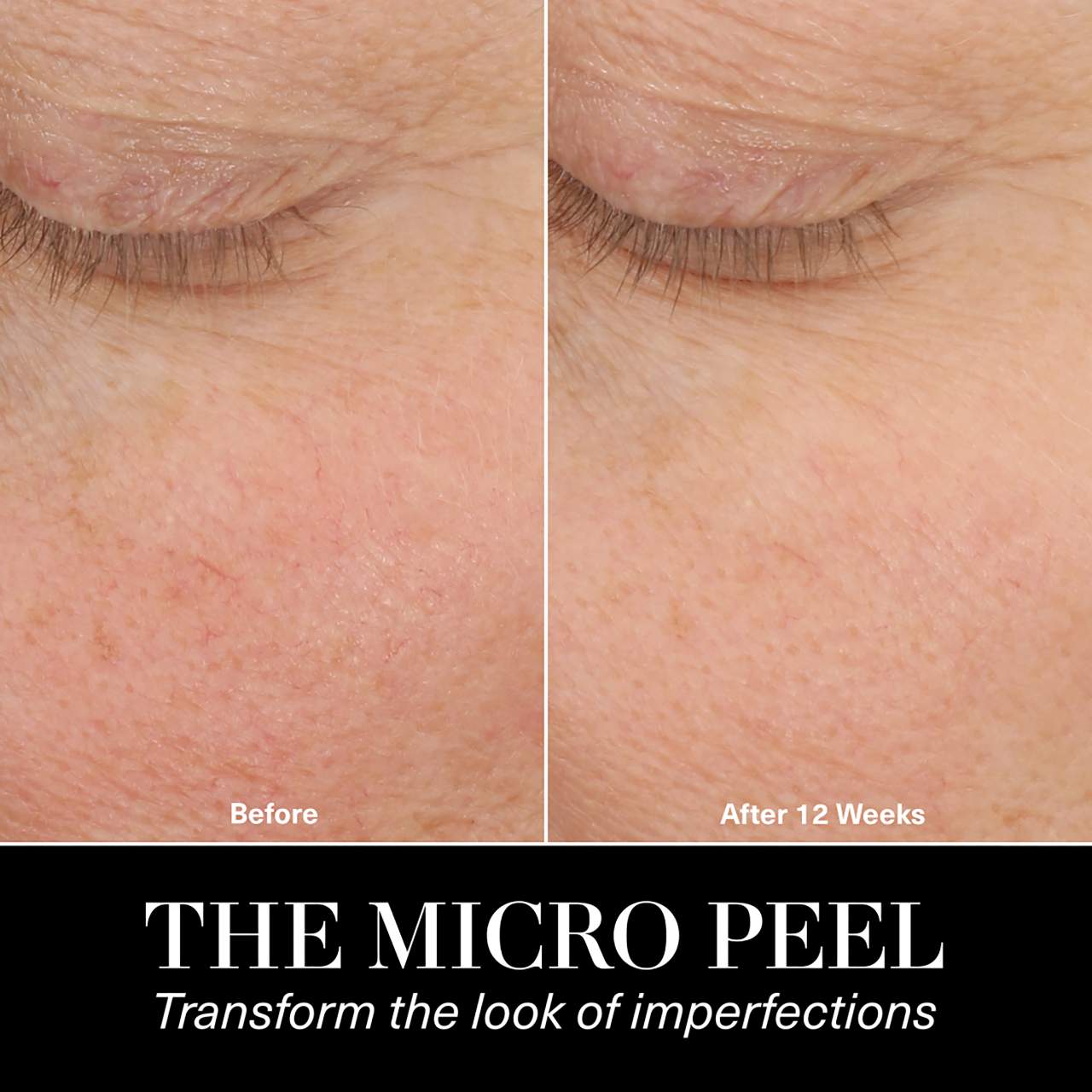 The Resurfacing Micro Peel For Fine Lines And Wrinkles | Cosmopolitan Shop
